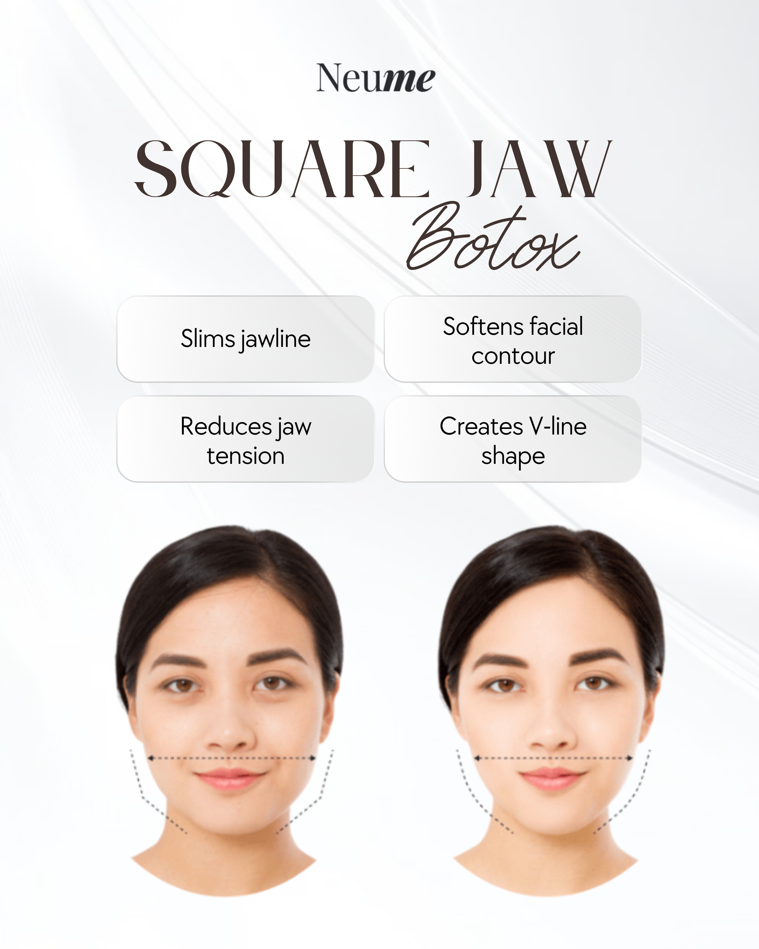 Jaw Botox — Neume Services
