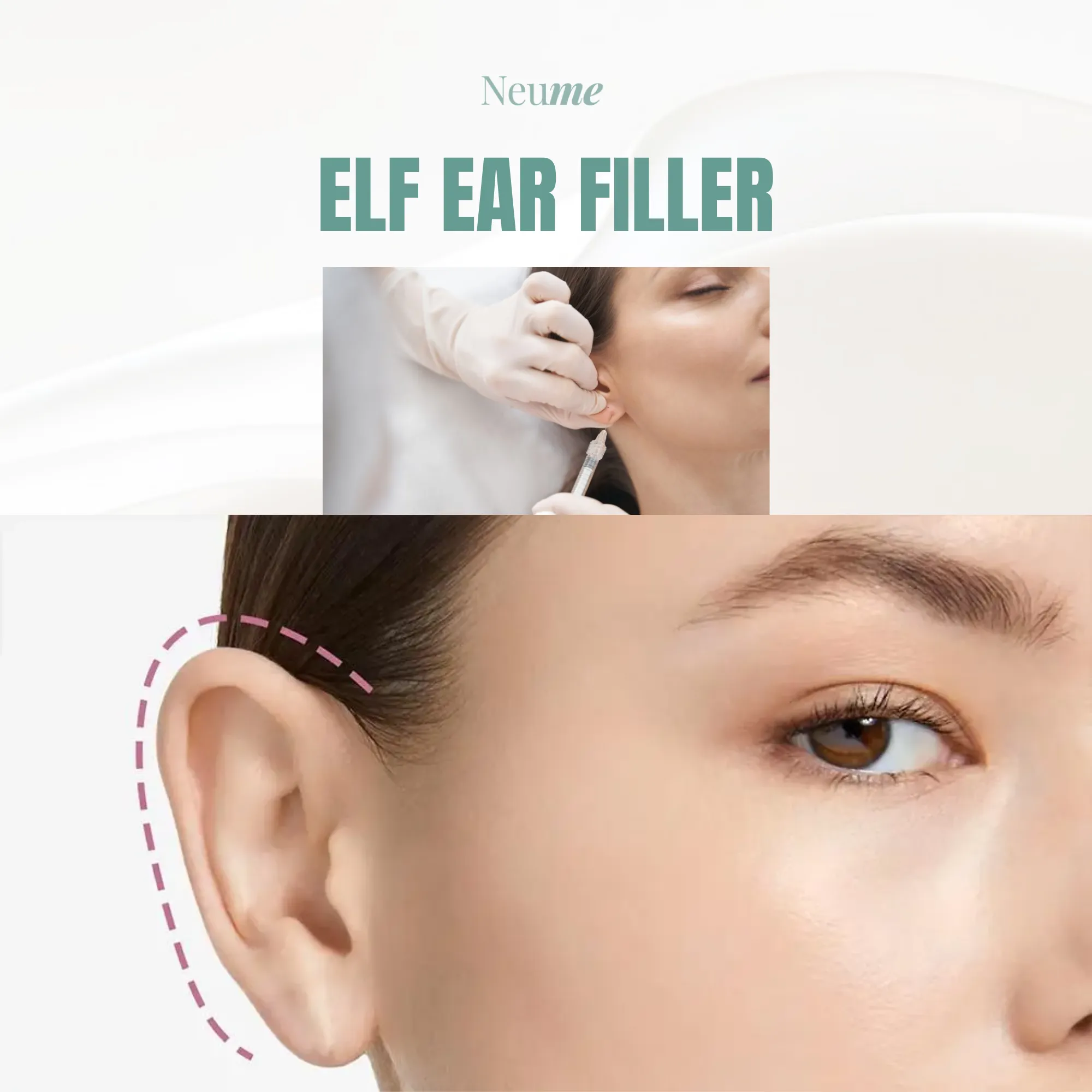 Elf Ear Filler — Neume Services