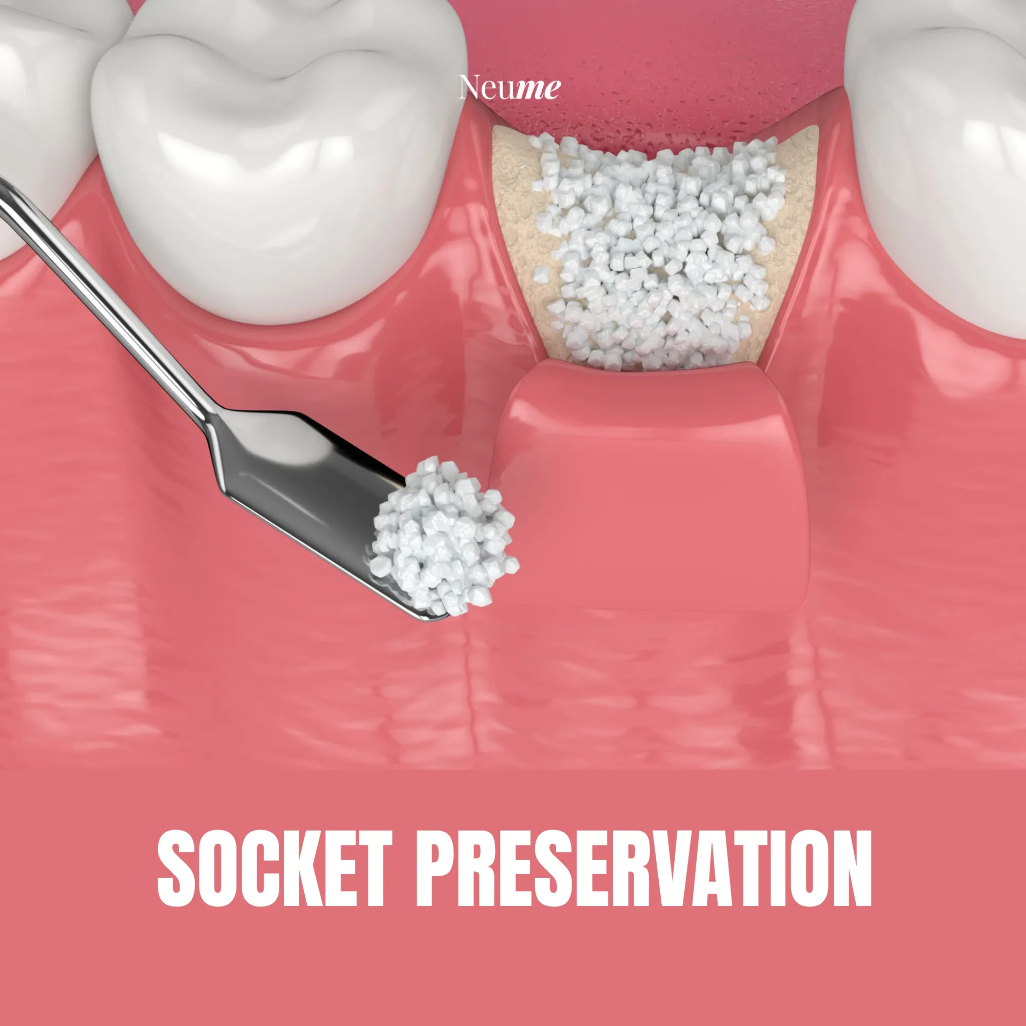 Socket Preservation — Neume Services